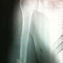 PWTorch.com - UFC NEWS: See the X-Ray of the arm Frank Mir broke at UFC ...
